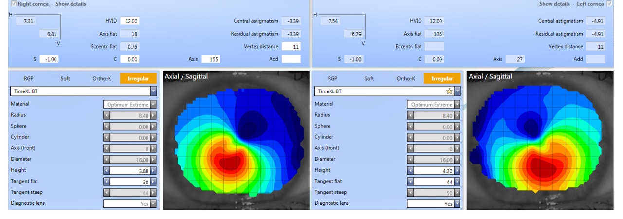 EasyFit App – ProCornea